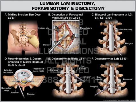 Lumbar Laminectomy Foraminotomy And Discectomy