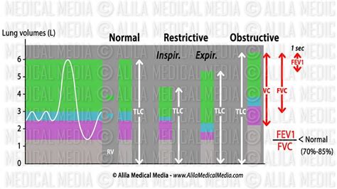 Alila Medical Media Spirometry For Differentiating Between