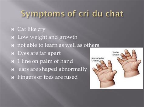 Cri Du Chat Syndrome Symptoms