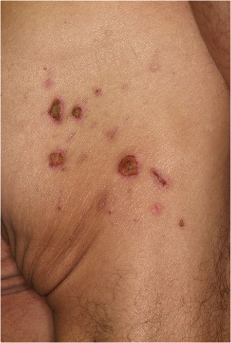 Mucous Membrane Pemphigoid Mild