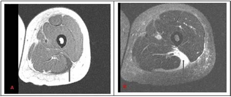 Axial T1 A And T2b Weighted Mri Of Left Lower Extremity Showing