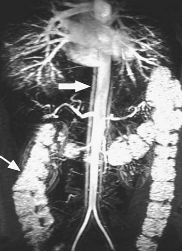 Magnetic Resonance Angiography In The Abdomen And Pelvis Abdominal Key