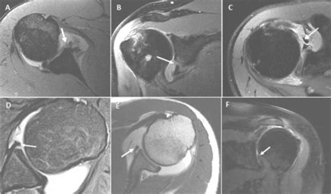 Bankart Lesions Orthovellum