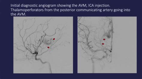 Transvenous Embolization Of Thalamic Arteriovenous Malformation Under