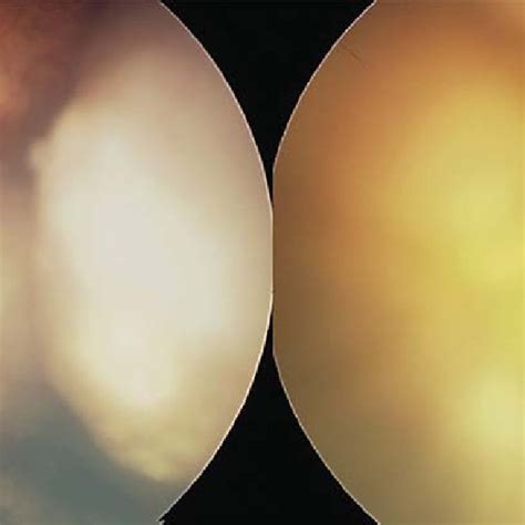 Fundus Photographs At Onset Showing Bilateral Advanced Retinoblastoma