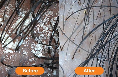 Dandruff Under Microscope