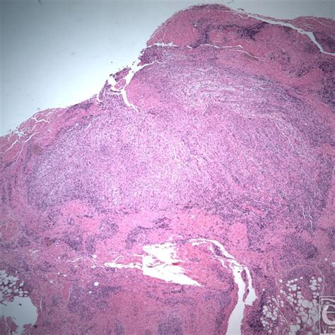Non Caseating Granuloma Lower Power Download Scientific Diagram