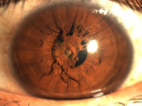 Iris Growing Over Pupil R Cringekeeper