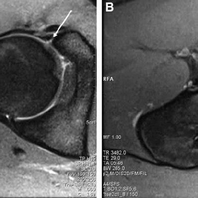 Acetabular Labral Tear A Compared With Normal Hip Anatomy B A