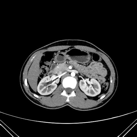 Renal Failure Analysis Classification Model By Mini Project