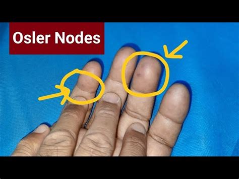 Osler Nodes Endocarditis Cardiovascular Pathology Bacterial