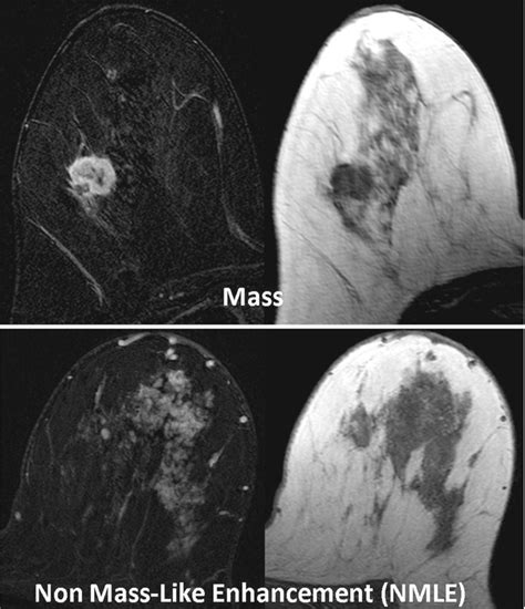 Breast Mri For Diagnosis And Staging Of Breast Cancer Oncohema Key
