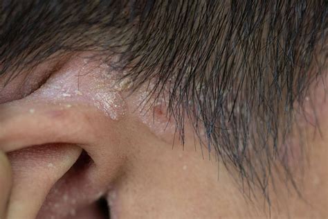 What Causes Dandruff Flakes