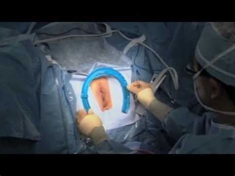 Lone Star Aps Retractor Setup Youtube