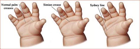Schizophrenia Palm Reading Perspectives