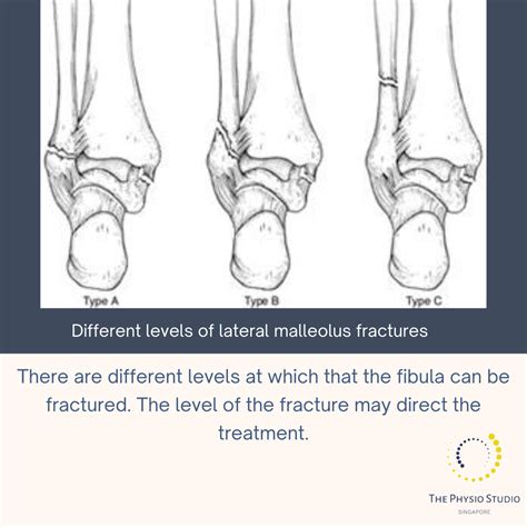 Lateral Malleolus Fracture