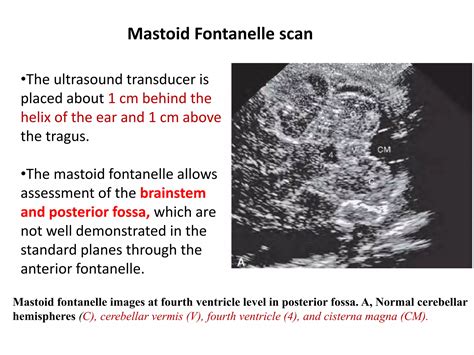 Neonatal Transcranial Usg Ppt