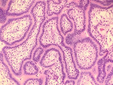 Plexiform Ameloblastoma Histology