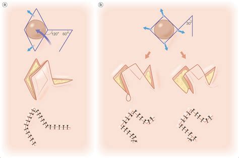 Transposition Flap