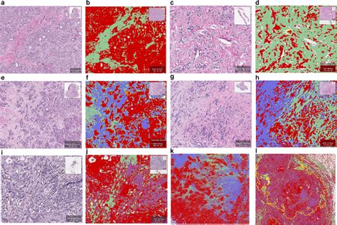 Computational Portraits Of The Tumoral Microenvironment In Human Breast