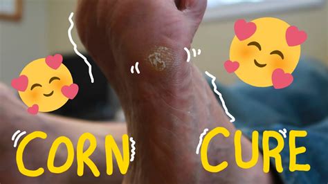 Corn Removal Full Treatment How To Really Cure Your Corn Youtube