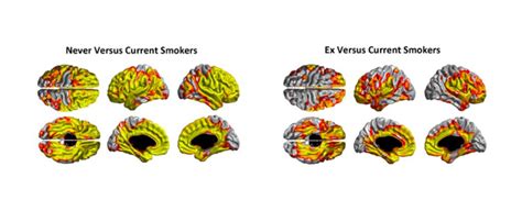 Smoking Thins A Vital Part Of Your Brain But Quitting Reverses The