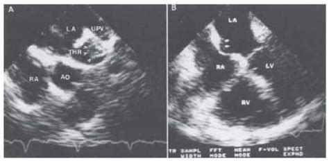 Updated Indications For Intraoperative Tee Thoracic Key