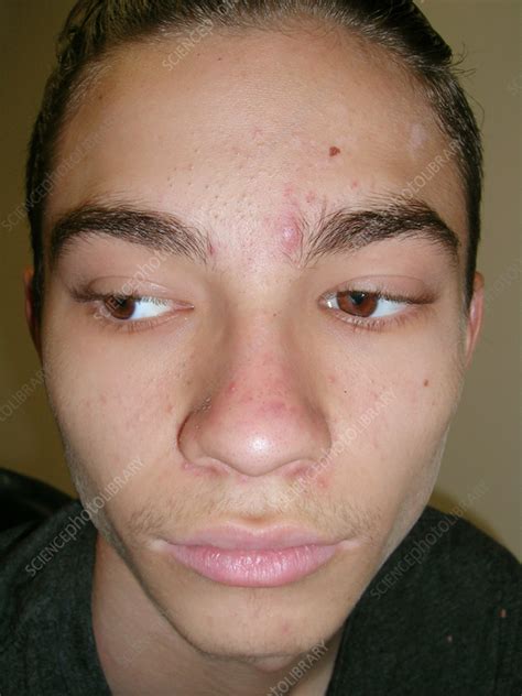 Vitiligo And Acne Stock Image C0604919 Science Photo Library