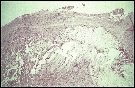 Histopathology Artifacts Quiz Flashcards Quizlet