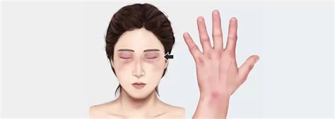 All You Need To Know About Dermatomyositis Rbh