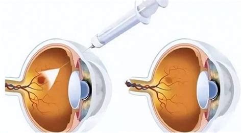 Sandoz Receives Ec Approval For Biosimilar To Eylea For Retinal