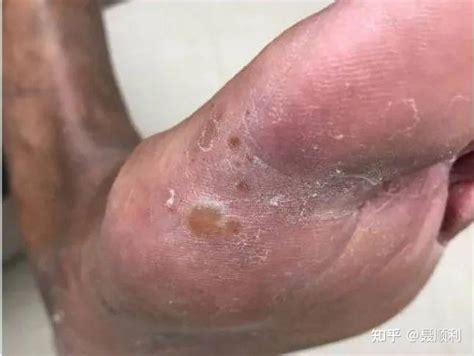 银屑病分型详解：掌跖脓疱型银屑病的诊断与治疗 知乎