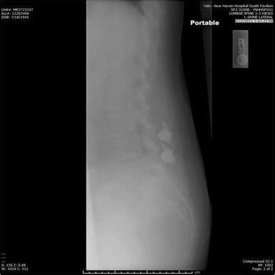A Radiograph Of Mild Anterolisthesis Of L4 On L5 In The Setting Of