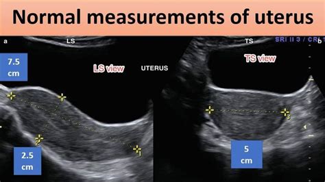Pin By Stelios Daskalogiannis On Uterus Medical Ultrasound