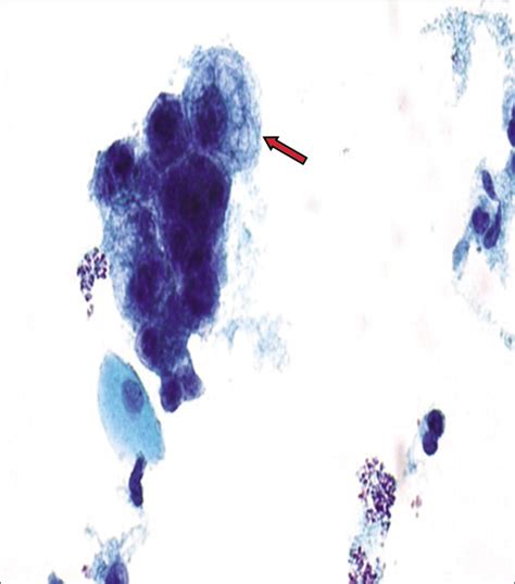 Atypical Glandular Cells Agc Cytology Of Glandular Lesions Of The