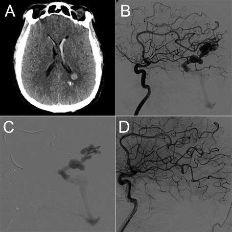 Male Patient In His 40s Presenting With Acute Onset Of Headache Download Scientific Diagram