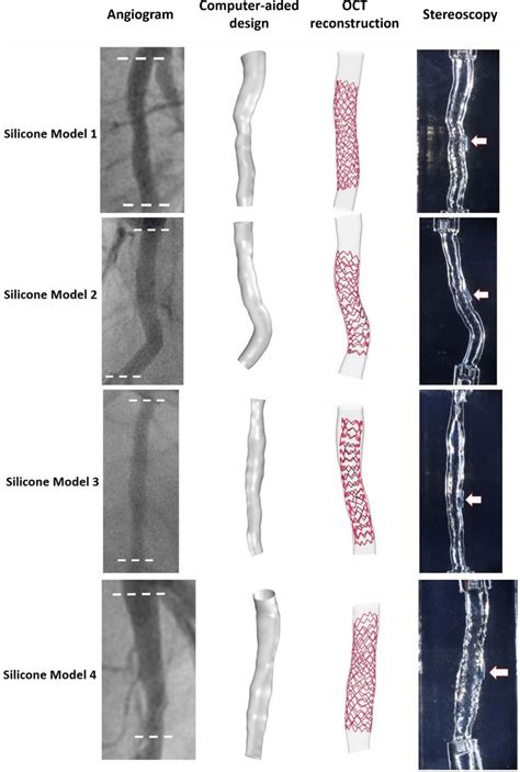Patient Specific Silicone Models In Each Model From Left To Right Download Scientific Diagram
