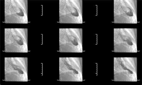 Ventriculography Showing Hypokinesia In The Inferoapical Wall Of The