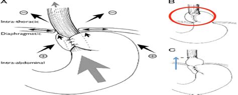 The Nissen Hill Hybrid Repair Experience With The First 500 Annals
