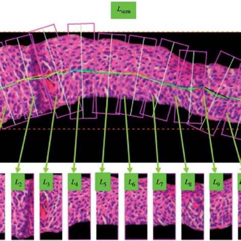 The Cin Grading Image Samples Anormal B Cinii C Ciniii D Download Scientific