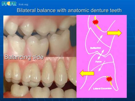 Ncepts Of Complete Denture Occlusion Ppt