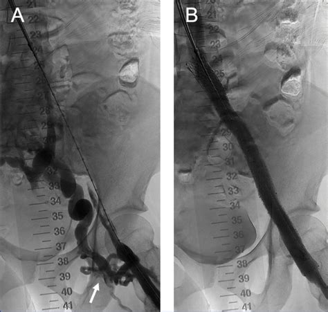 Lower Limb Venogram Of A 37 Year Old Female With Postthrombotic