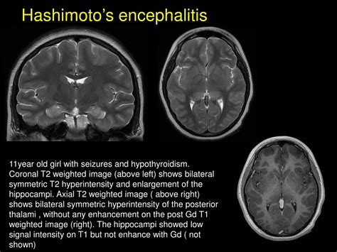 Ppt Imaging Spectrum Of Pediatric Encephalitis Viral Autoimmune