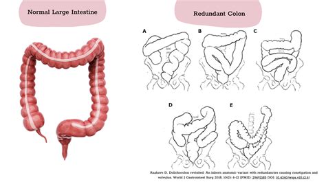 The Endo Belly Problem Youve Never Heard Of A Redundant Colon — Heal Endo