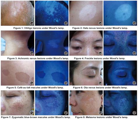 Woods Lamp Examination A Comprehensive Guide To Skin Disease