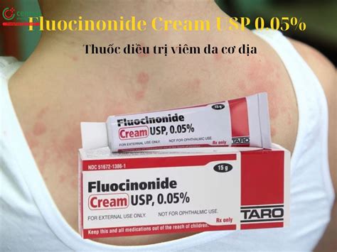 Thuốc Fluocinonide Cream Usp 005 Trị Viêm Da Cơ địa Vảy Nến