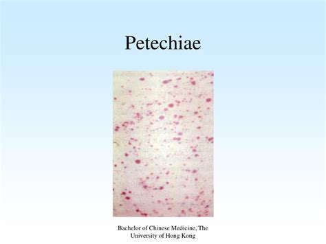 Ppt Bleeding Disorders Powerpoint Presentation Free Download Id