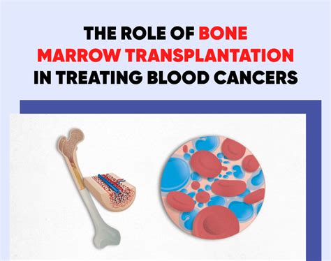 Bone Marrow Test Procedure How Does It Work