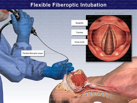 Flexible Fiberoptic Intubation