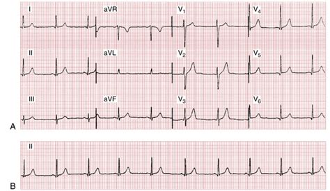 Ecg Leads Thoracic Key